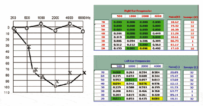 A Clinician’s Encounter with the Auditory Steady-State Response (ASSR ...
