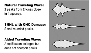 Identifying Cochlear Dead Spots | The Hearing Review