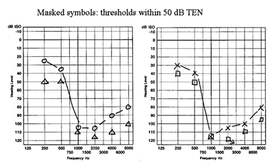 Identifying Cochlear Dead Spots | The Hearing Review
