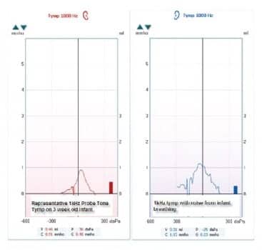 Tympanometry and Acoustic Reflex: Innovation, Review, and Application ...
