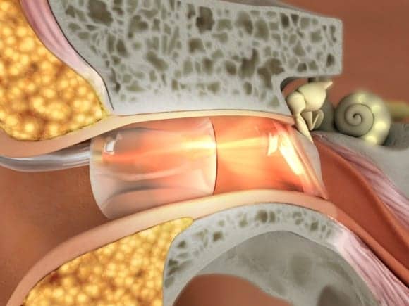 EarLens Corporation Releases More Information About EarLens System