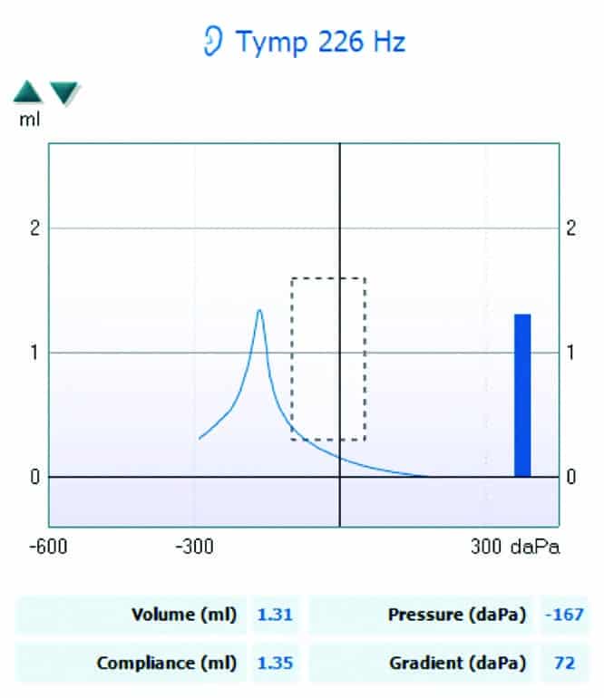 Otoacoustic Emissions and Pressurized OAEs