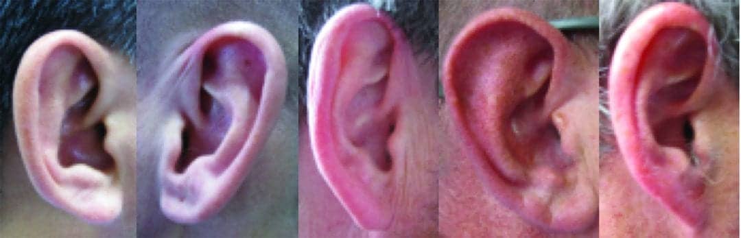 An Innovative Otoblock that Enables Deeper Impression Taking | The ...