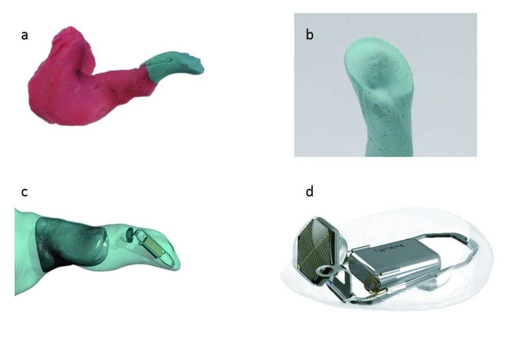 The Earlens Light-Driven Hearing Aid: Top 10 Questions and Answers ...