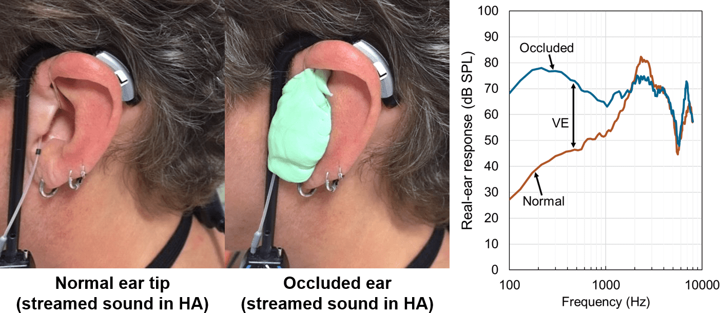 Challenges of Instant-Fit Ear Tips: What Happens at the Eardrum? | The ...